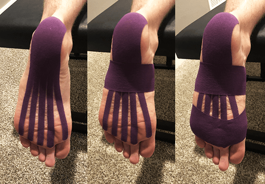 Can A Chiropractor Help Fix Metatarsalgia (Forefoot Pain)? | Ascent ...